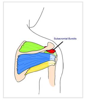 Subacromial Bursitis
