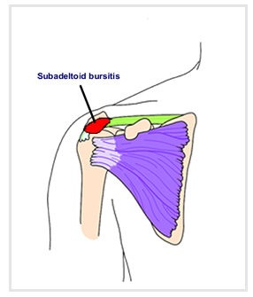 Subdeltoid Bursitis Natural Treatment | OSMO Patch US