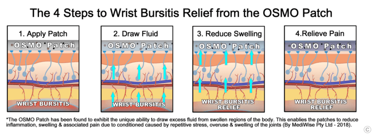 Wrist Bursitis Natural Treatment | OSMO Patch US